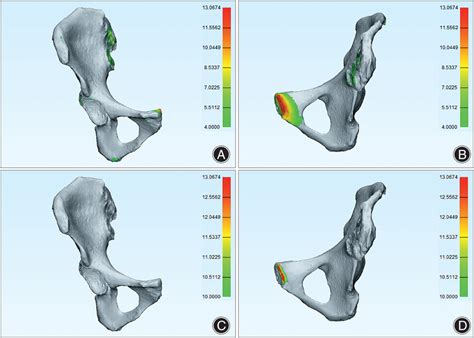 Deviation Color Maps Dcms Of A Hip Bone With Colored Regions Showing