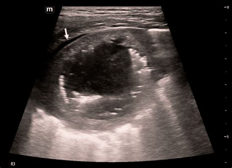 Lung Pocus Archives Pocus Journal