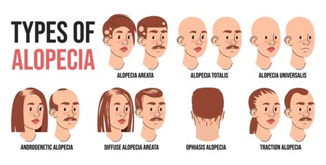Diffuse Alopecia Man Royalty Free Images Stock Photos Pictures Shutterstock