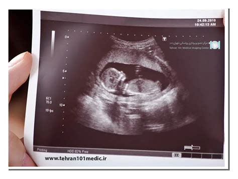 اشتباه سونوگرافی در تعیین جنسیت دختر چقدر است؟ راهنمای کامل و نکات