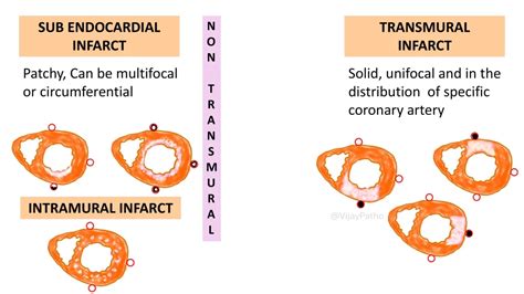 Myocardial Infarction Pathogenesis And Infarct Types Pathology Made Simple