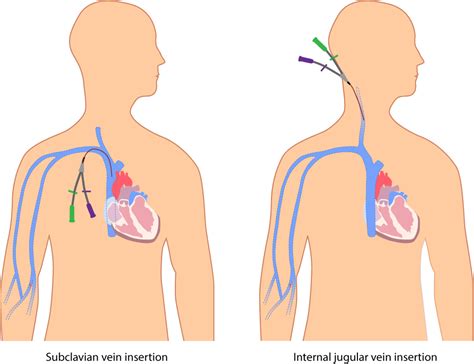 Exploring Percutaneous Central Venous Catheter Cvc Insertion