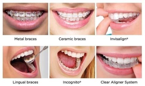 Which Type Of Braces Are The Best Simadentclinic