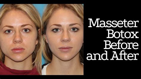 Masseter Botox Before And After Results And Effects