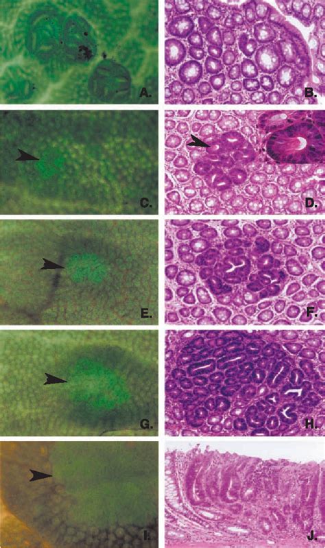 figure 1 from flat dysplastic aberrant crypt foci are related to