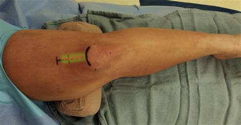 Suprapatellar Tibial Nailing Orthopedic Clinics