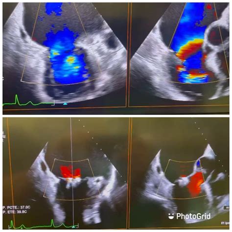 Rodrigo Estévez Loureiro Md Phd Fesc On Linkedin Pascalprecision Teer