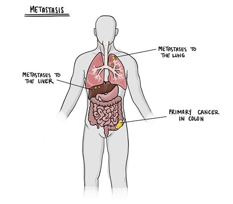 Metastasis Mypathologyreport