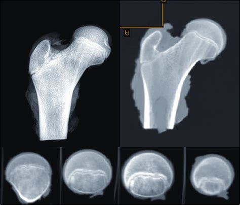 Femur Growth Plate 93 Growth Plate Arrest Radiology Key