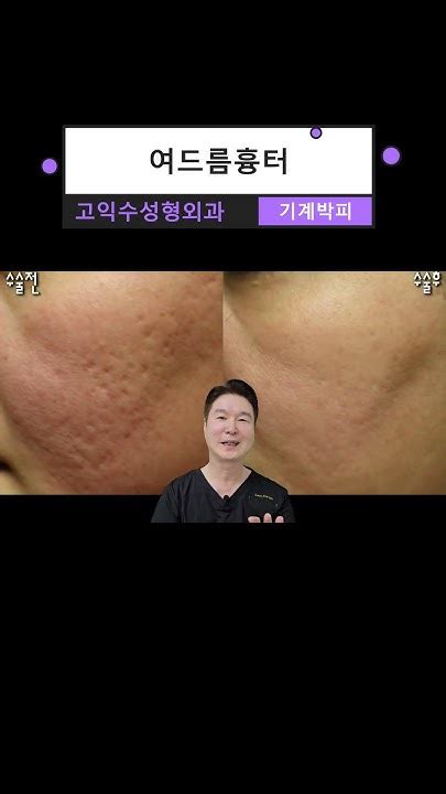 여드름흉터 효과 없는 치료 이제 그만 하시고 고익수성형외과의 기계박피로 콤플렉스를 한번에 해결하세요 Youtube