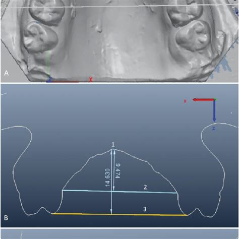 Palatal Height Measurements A The Black Line Marked B Indicates The Download Scientific