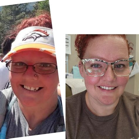 21 Months Later R Braces