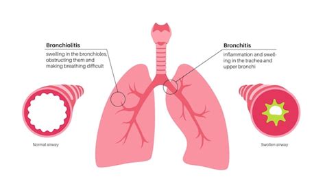 Premium Vector Bronchitis And Bronchiolitis