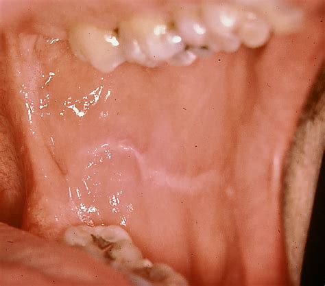 Benign Chronic White Lesions Of The Oral Mucosa Treatment
