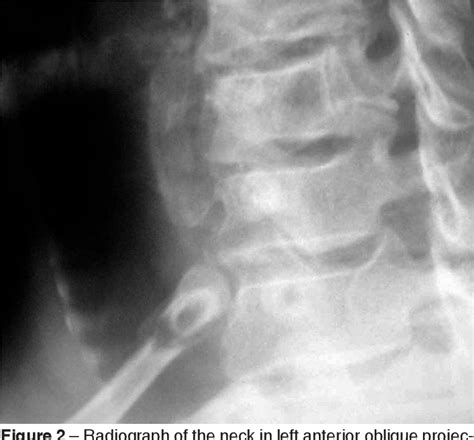Figure 2 From Bilateral First Rib Fracture In A Dive With Life Vest Semantic Scholar