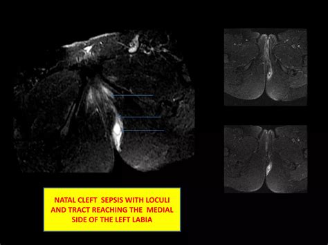 Pilonidal Sinus Pptx