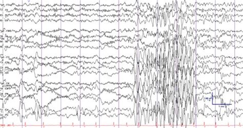 The Pediatric Eeg