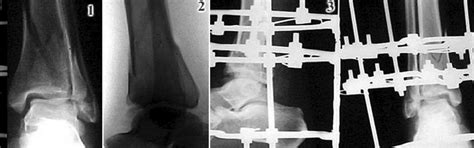 1 And 2 Pre Operative Radiographs Of Open Type B Pilon Fracture And Download Scientific