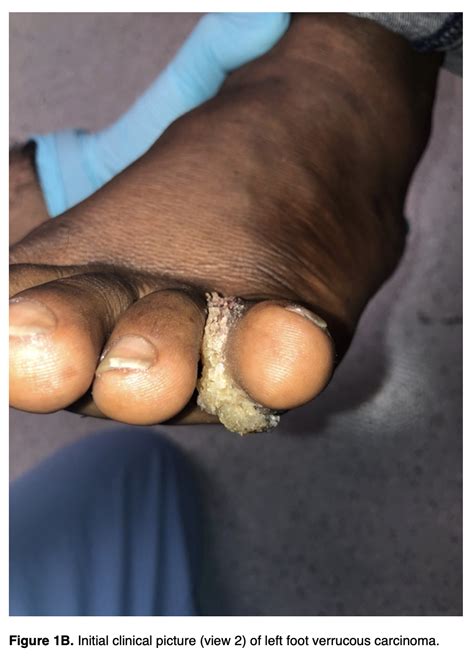 When Pedal Verruca Vulgaris Is Actually Verrucous Carcinoma Podiatry