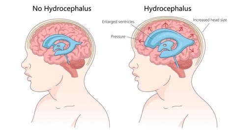 Hydrocephalus Causes Symptoms And Treatment