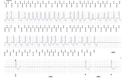 James Ong Md Facc Fhrs On Linkedin Afib Af Sss Sicksinus Bradycardia Syncope