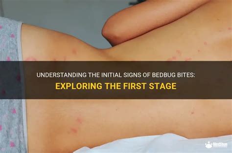 Understanding The Initial Signs Of Bedbug Bites Exploring The First Stage Medshun