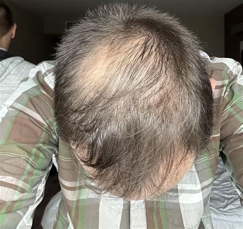 before after ht overlay r hairtransplants