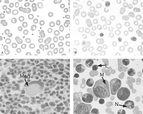Inherited Platelet Disorders Oncohema Key