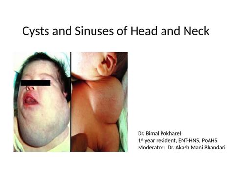 Cysts And Sinus Of Neck In Head And Neck Cancerpptx