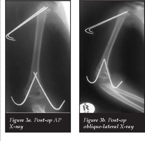 Figure 3 From The Paediatric Floating Arm Or Segmental Humerus Fracture A Case Report