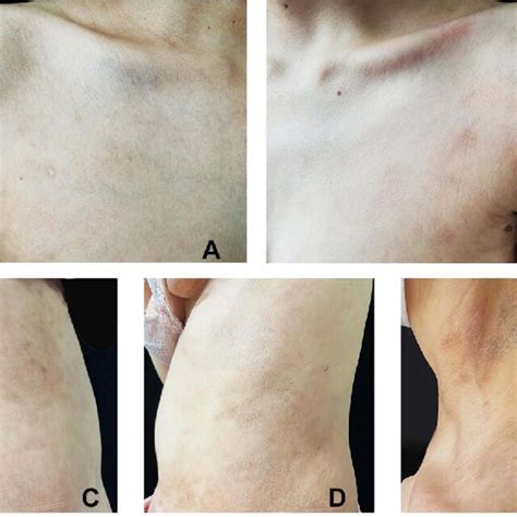 A Band Like Distribution Of Lichen Planus Like Lesions Was Observed On