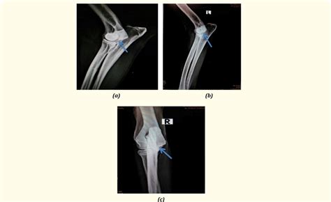 Extended Mediolateral Radiographic Projection Showing The Subchondral Download Scientific
