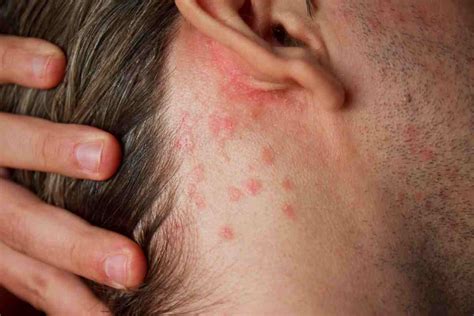 Stress Skin Rash The Triggers Breaking Latest News