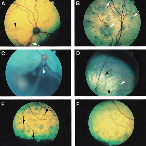 Retinal Hemorrhage Hypertension