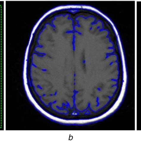 Results For Real Brain Mri Image With The Hybrid Region Based Model A