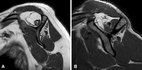 Classifications In Brief Goutallier Classification Of Fatty