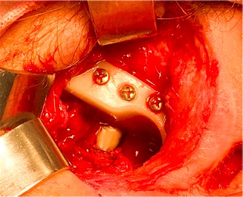 Tmj Gold Prosthesis And Uhmwpe Glenoid Fossa Download Scientific Diagram
