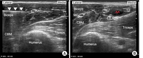 Figure 1 From Ultrasound Guided Axillary Brachial Plexus Block