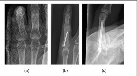 Figure 2 From Intramedullary Headless Screw Fixation For Fractures Of The Proximal And Middle