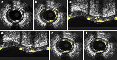 Characterizing Calcified Region A Ivus Image B High Intensity Plaque Download Scientific