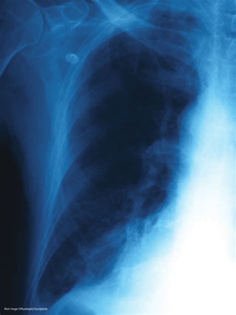 Pdf Pathogenesis And Diagnosis Of Bronchiectasis
