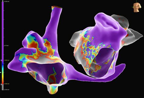 Iatrogenic Biatrial Flutter The Role Of The Bachmanns Bundle