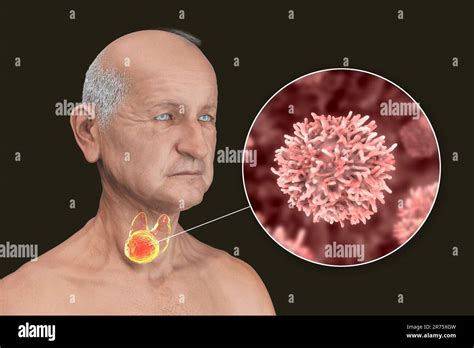Thyroid Gland Cancer With Closeup View Of Cancer Cells Computer