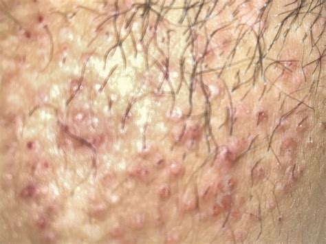 여자 생식기 모낭염 지식in