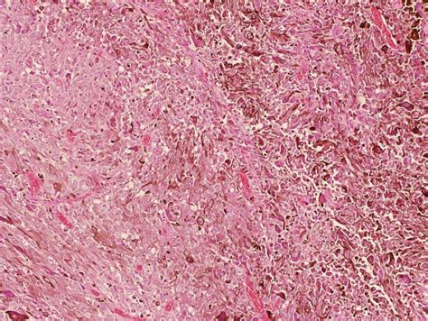 Ahmad Al Qurashi On Linkedin Inguinal Lymph Nodes Excision Showing Melanoma Metastatic With…