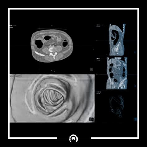 Colonoscopia Virtual Nortac