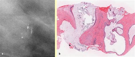 Benign Microcalcification And Its Differential Diagnosis In Breast Screening Diagnostic
