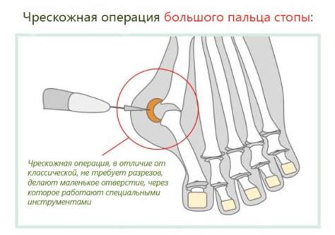 Операция халюс вальгус - особенности, реабилитация
