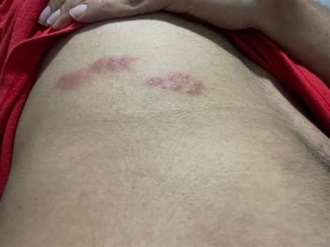 Shingles Medication Rshingles