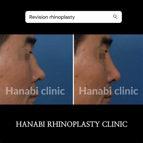 Before And After Photo Of Saddle Nose Correction With Septal
